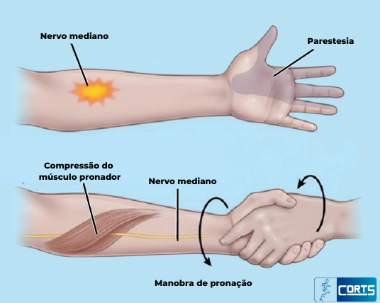 Síndrome do pronador redondo: causas e tratamento